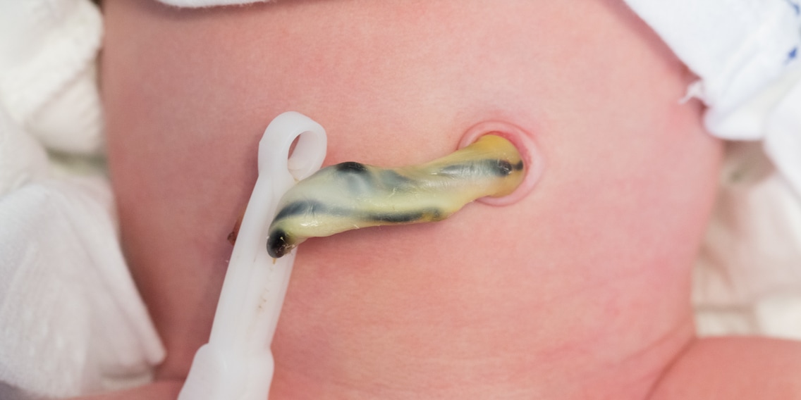 Nabelschnur: Fakten über Länge, Anatomie und Abnabelung nach Geburt ...